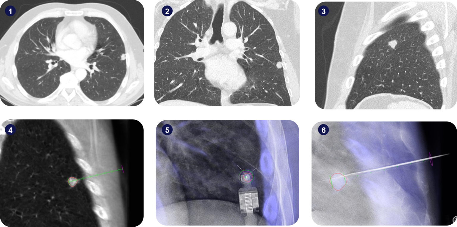 Micromate Case Report Robotic Assisted Lung Biopsy micromate-case-report-robotic-assisted-lung-biopsy