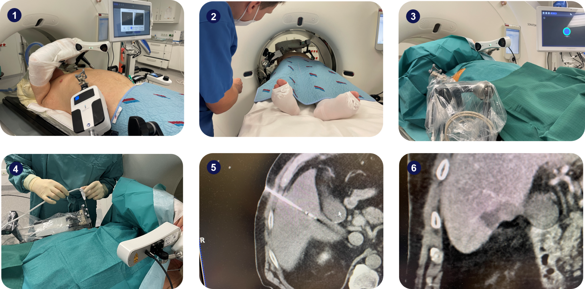 Micromate™ Case Report: CT-Guided Microwave Ablation of the Liver