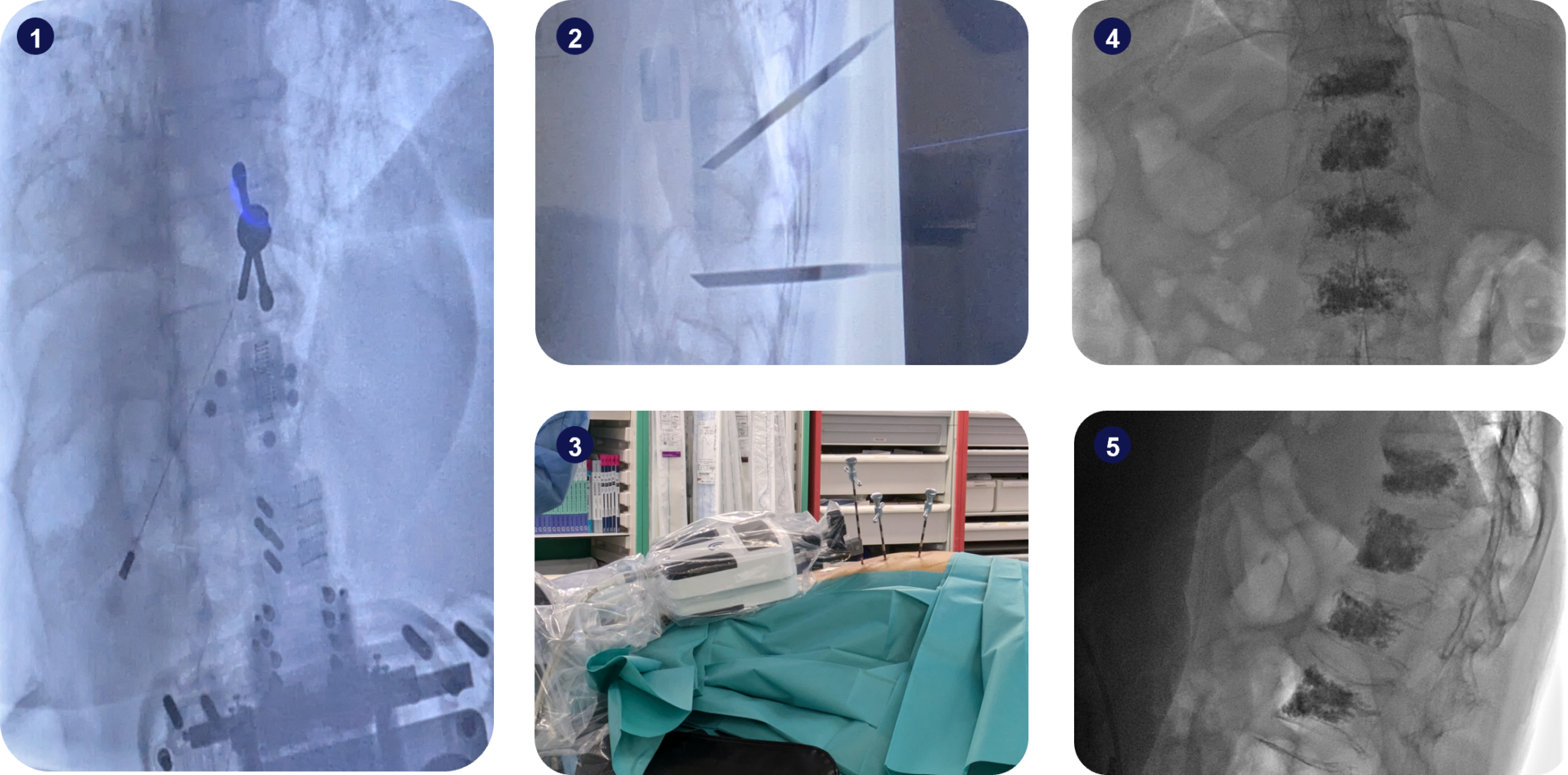 Micromate™ Case Report: Robotic-assisted, CBCT-Guided Vertebroplasty